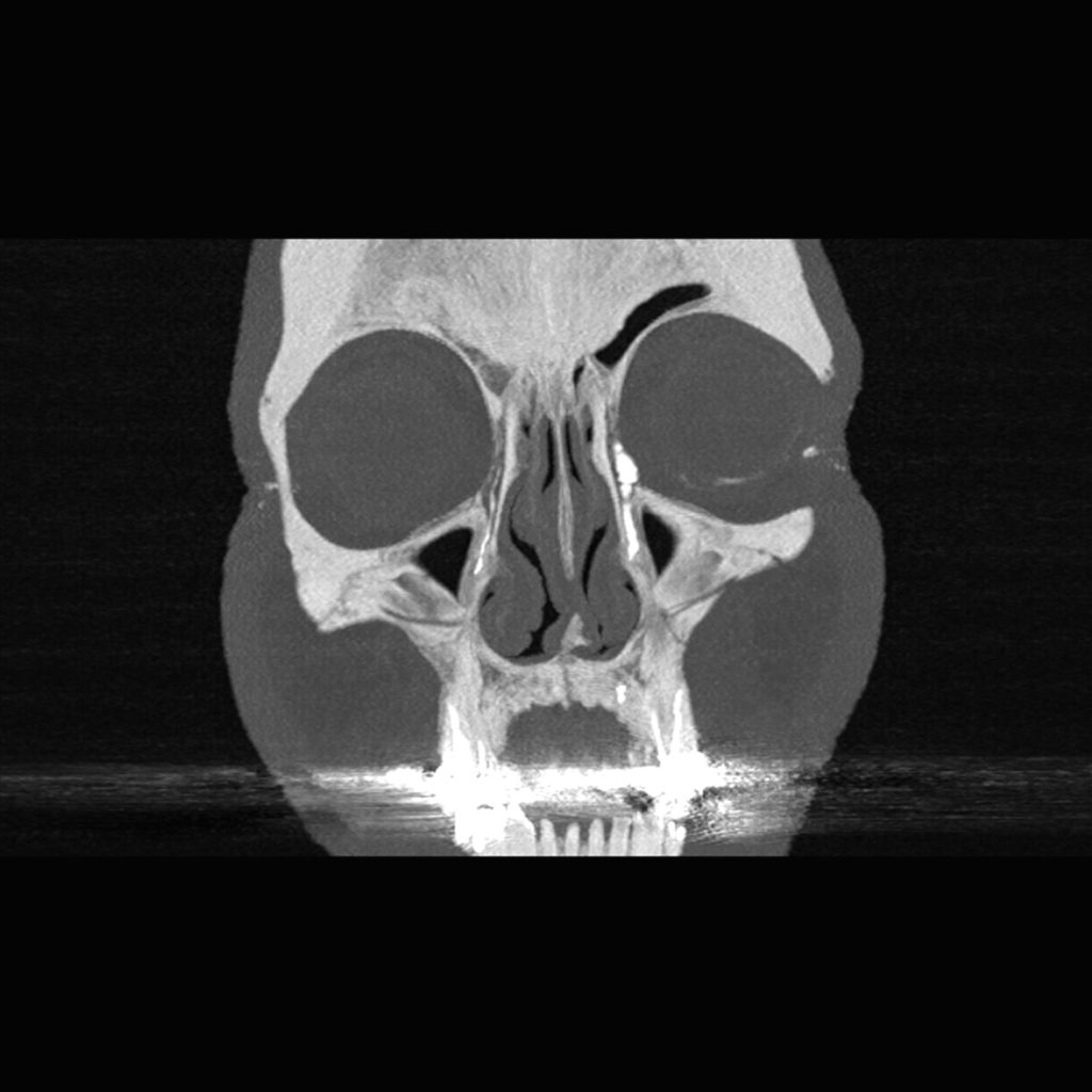 Imagerie des voies lacrymales - Radiologie Corinne Bordonne