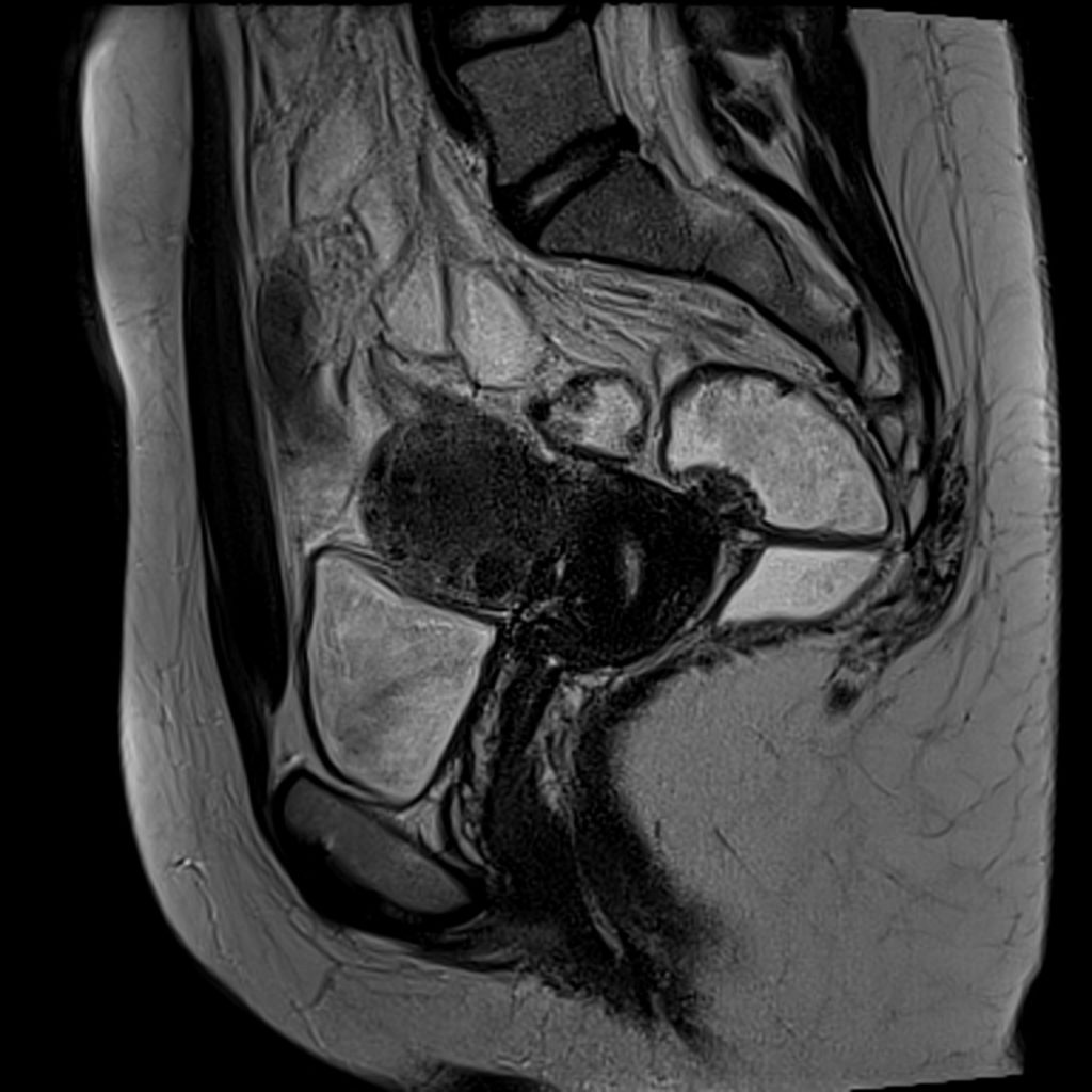 Exploration de l'endométriose digestive : entéro IRM - Radiologie ...